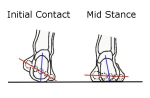 Forefoot Varus and Supinatus - Somastruct