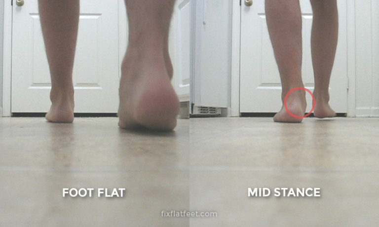 The Difference Between Flat Feet and Overpronation - Somastruct