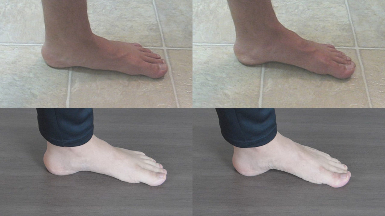 My Before and After Progress with the Short Foot Exercise - Somastruct