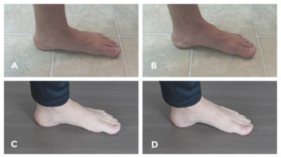 My Before and After Progress with the Short Foot Exercise - Somastruct