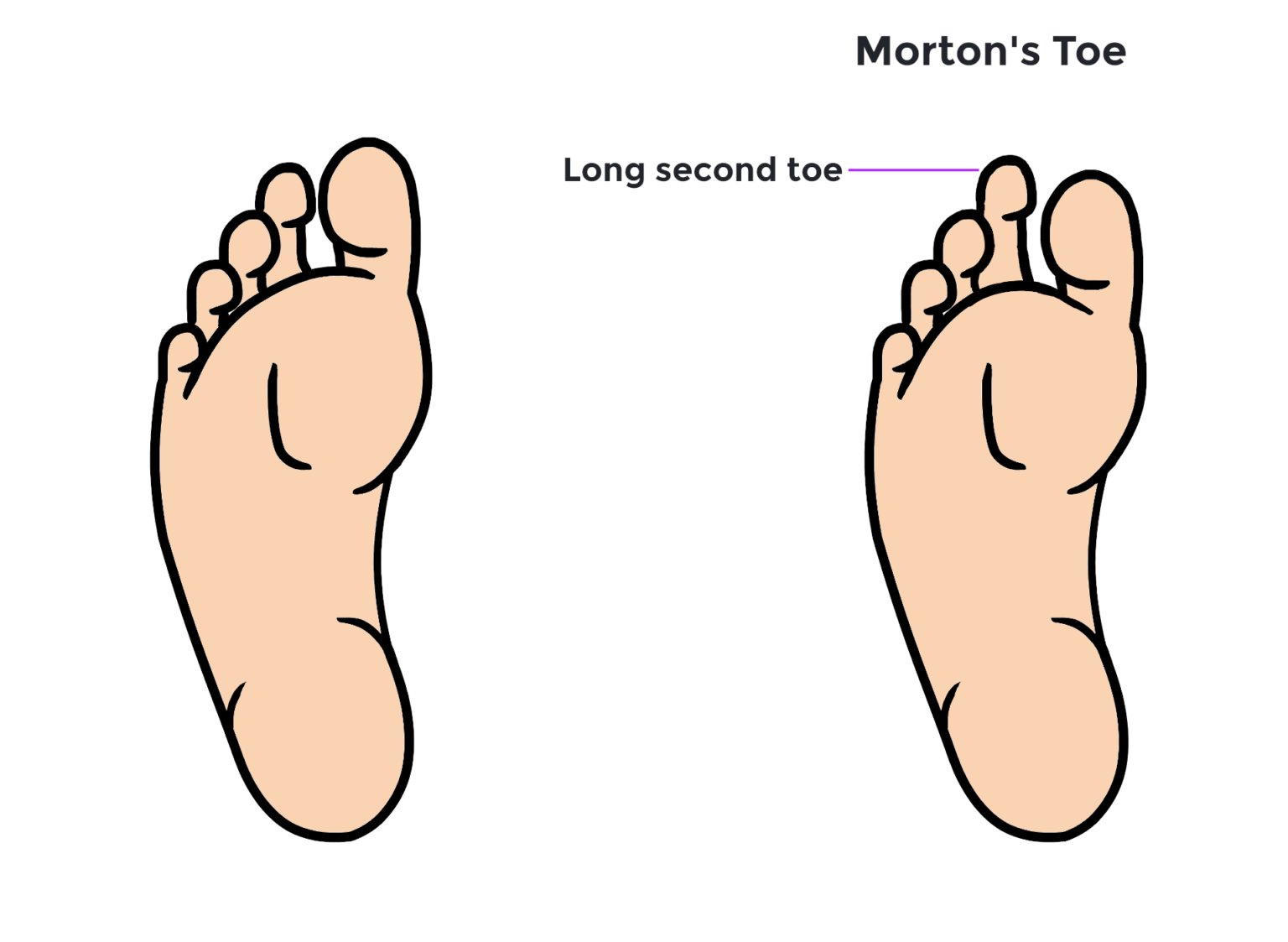Morton's Toe: A Long Second Toe - Somastruct