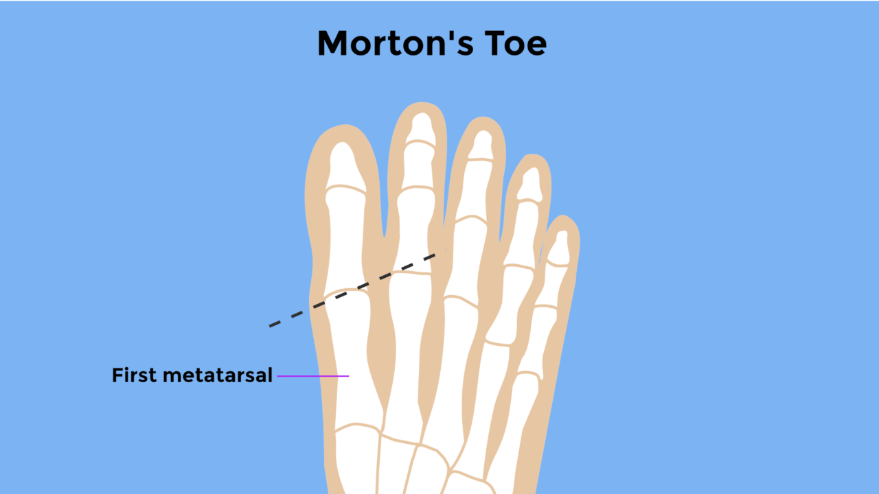 Morton's Toe: A Long Second Toe - Somastruct